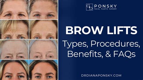 How The Brow Lift Went Mainstream Avkiu
