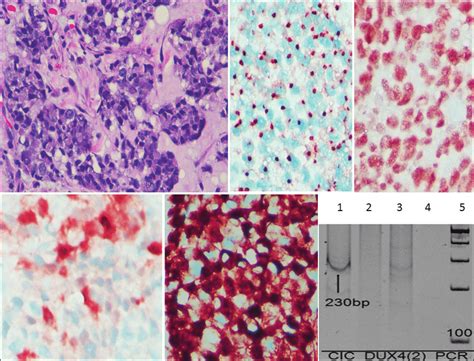 Case 37 Undifferentiated Round Cell Sarcoma A Round To Polygonal Download Scientific