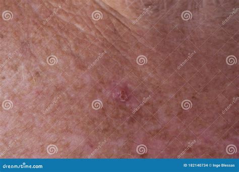 Basal Cell Cancer Chest At Cecil Messer Blog