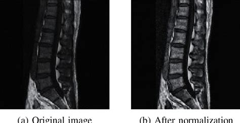 Figure 4 From Auto Segmentation Of Lumbar Vertebrae Using Multiplanar Unet Semantic Scholar