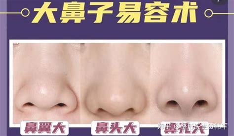 鼻翼肥大的人如何变身精致美人？ 知乎