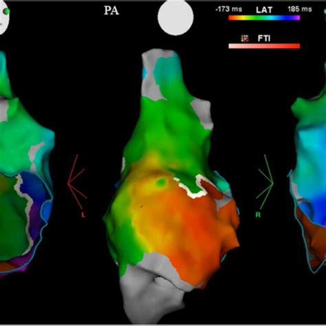 Activation Mapping Of Carto System The Patient Was Diagnosed With Download Scientific Diagram