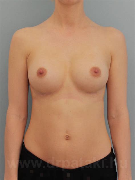 Breast Augmentation With Anatomical 225 And 255 Cc High Projection