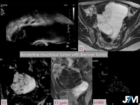 Selma Beljord Diffusion Perfusion Mri In Ovarian Lesions Jfim Ifupi