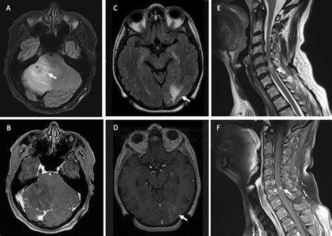 Atypical Presentations Of Malt Primary Cns Lymphomas A And B Patient