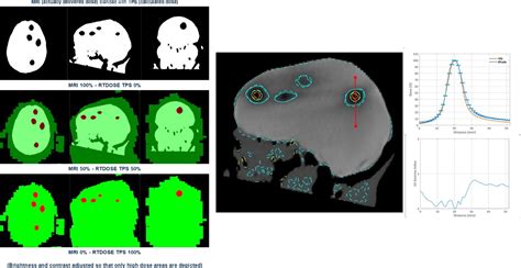 A Need For 3d Evaluation In Single Iso Multi Focal Srs Isrs