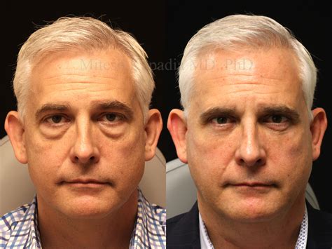 Before And Six Months After Upper And Lower Blepharoplasty Surgery