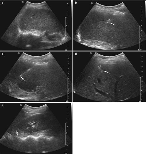 Liver Biopsy Radiology Key