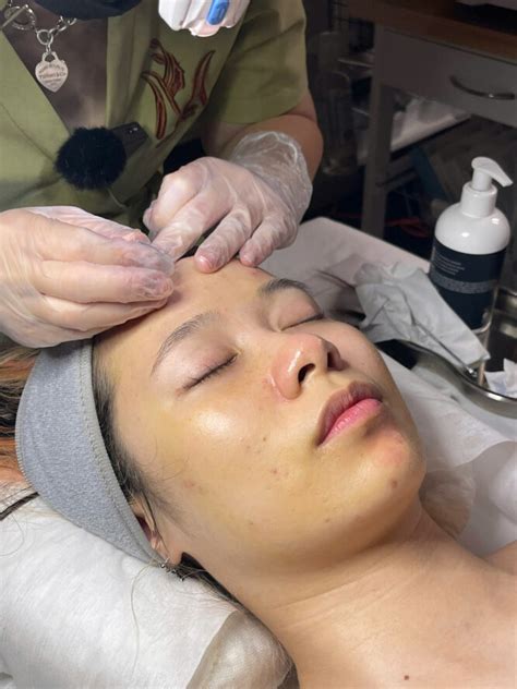 Acne Extraction Petersham Free Parking Led 110 Mystic Spa And Wellness