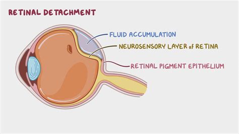 Video Detached Retina Nursing Osmosis