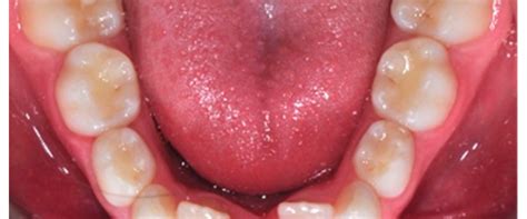 Mixed Dentition Period When Primary And Permanent Teeth Coexist