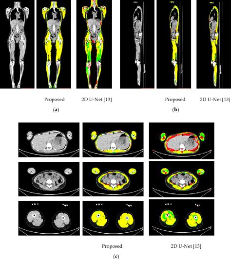 Figure 3 From Surface Muscle Segmentation Using 3d U Net Based On Selective Voxel Patch