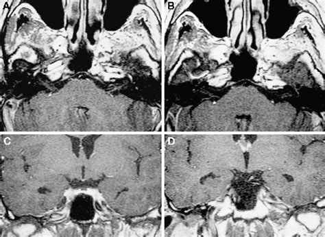 Structure Of Internal Carotid Plexus Semantic Scholar