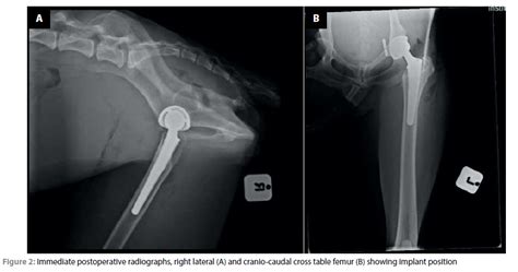 A Case Report Of A Cementless Total Hip Replacement Performed In A Pelvic Limb Amputee After A