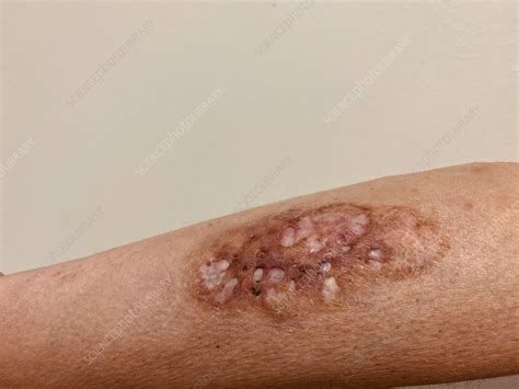 Pyoderma Gangrenosum After Diverticulitis Surgery Stock Image C056
