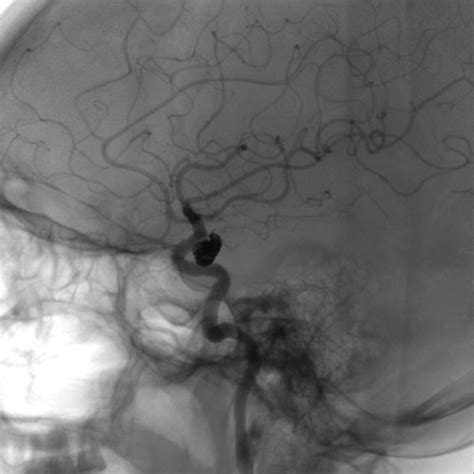 Cta Demonstrates A Cervical Left Internal Carotid Artery Dissection