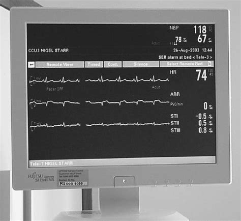1 Monitor Displays Three Leads And St Segment Monitoring Download