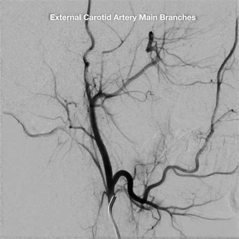 Internal Carotid Artery Angiogram