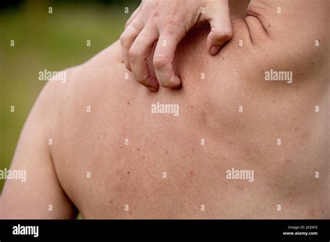 Hyperpigmentation On Back