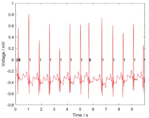 arma模型谱估计matlab 基于机器学习的心律失常分类 四 ——心电信号特征提取[matlab] csdn博客