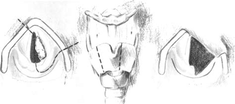 Frontolateral Laryngectomy Download Scientific Diagram
