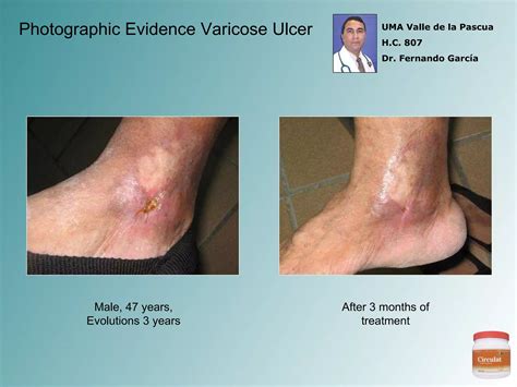 Varicose Ulcer Evidence Part Ii Circulat Ppt Skin And