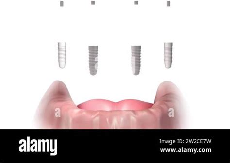 Schematic Animation Showing What Parts Ball Attachment Superstructure Is Made Of Lower Jaw