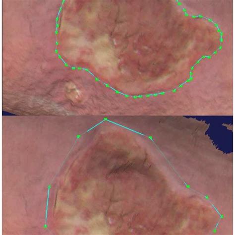 User Driven Selection Of The Lesion Border Approximate Border Shown On