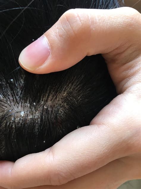 Dandruff Or Dry Scalp Rdandruff
