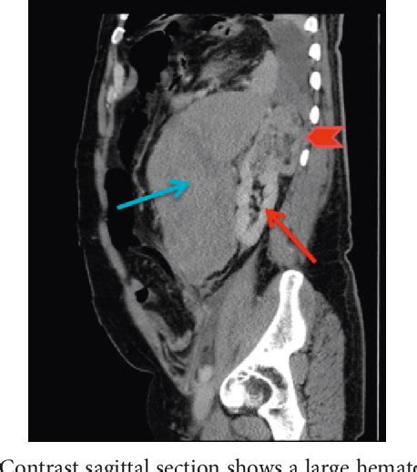 Figure 1 From Spontaneous Retroperitoneal Bleeding As A Complication Of Unusual Renal