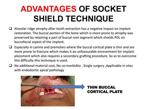 Socket Shield Technique Pptx