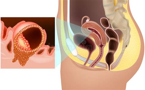 Implantation Of Fertilized Ovum In Uterus Implanted Human Embryo In