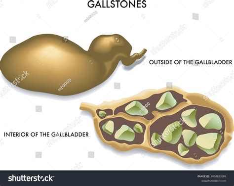 Medical Illustration Section Gallbladder Gallstones Stock Vector Royalty Free 2058183083