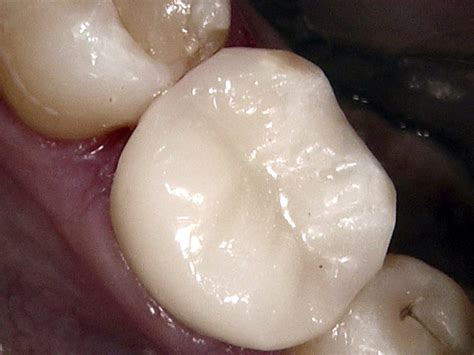 V3 Ring Creators Launch New Circumferential Matrix Band The Dental Review