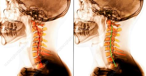 Curvature Of The Cervical Spine X Rays Stock Image C030 3784 Science Photo Library