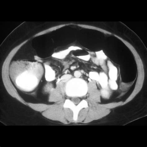 Pediatric Typhlitis Pediatric Radiology Reference Article Pediatric Imaging Pedsimaging
