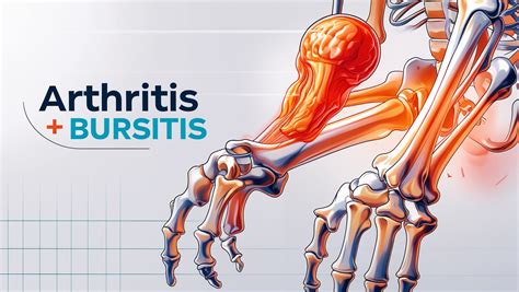 Arthritis And Bursitis Understanding Their Key Differences