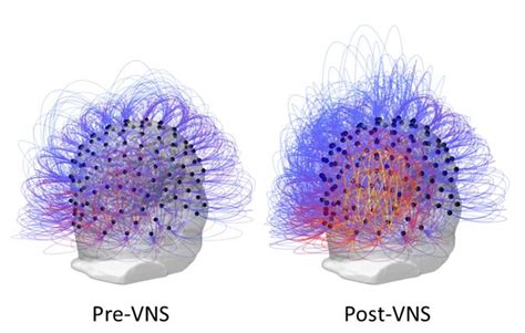 Man In Vegetative State For 15 Years Responds To Nerve Stimulation
