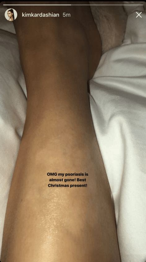Kim Kardashian S Psoriasis Is Almost Completely Gone