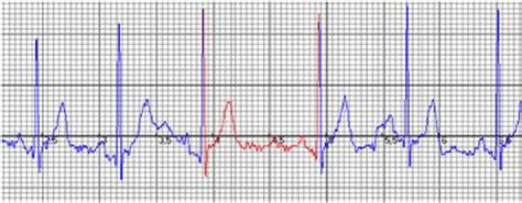 detection of the irregular rr interval download scientific diagram