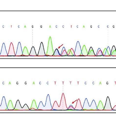 Chip Capture High Throughput Sequencing Result In The Patient A