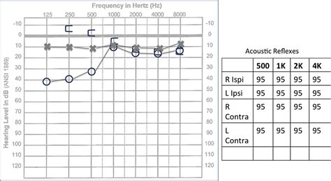 Clinical Evaluation Of The Patient With Otosclerosis Otolaryngologic