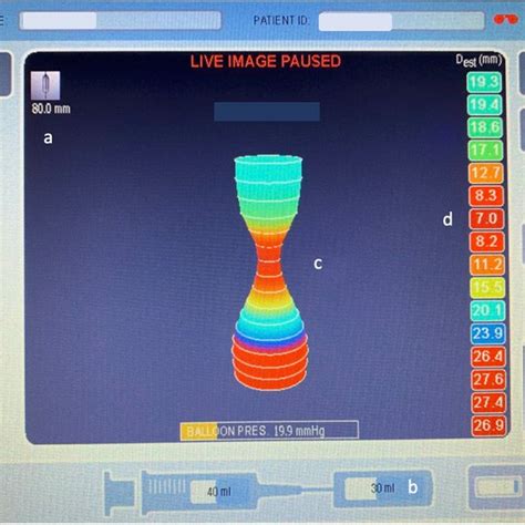 Photo Of The Endoflip Console That Shows Data About The Balloon Across