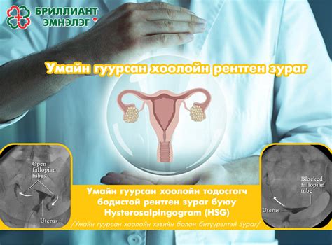 Умайнгуурсанхоолойнрентгензураг 🔶Умайн гуурсан хоолойн тодосгогч