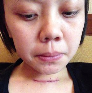 Life Without A Thyroid Positive Post Thyroidectomy Stories