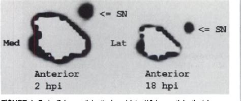 Figure From Impact Of Lymphoscintigraphy On Sentinel Node Identification With Technetium M