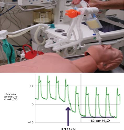 Intrathoracic Pressure Regulation To Treat Intraoperative Hy European Journal Of
