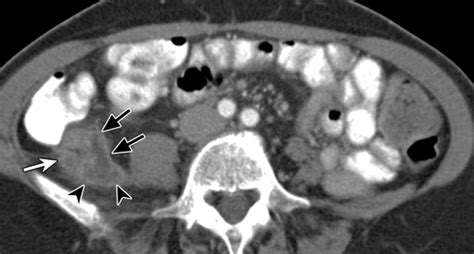 Neoplasms Of The Appendix Pictorial Review With Clinical And Pathologic Correlation Radiographics