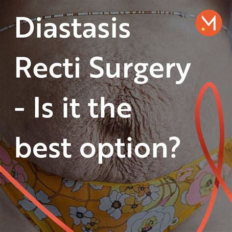 Diastasis Recti Surgery Mutu System In 2025 Operation