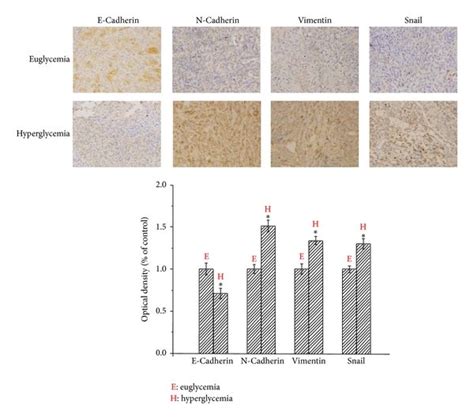 Effect Of Hyperglycemia On The Expression Of E Cadherin N Cadherin